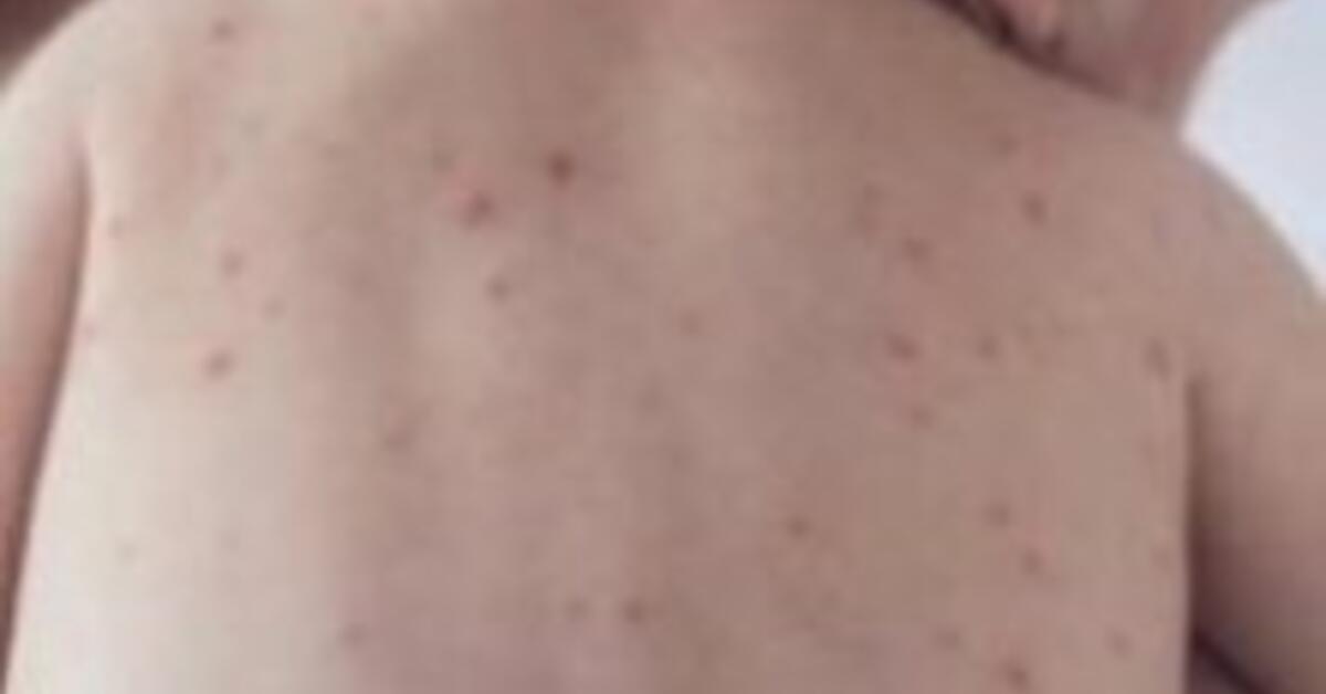 Five Additional Cases Identified in Ocean County Measles Outbreak Five Additional Cases Identified in Ocean County Measles Outbreak